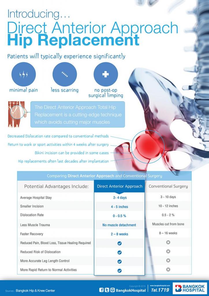 Introducing Direct Anterior Approach Hip Replacement | Bangkok ...