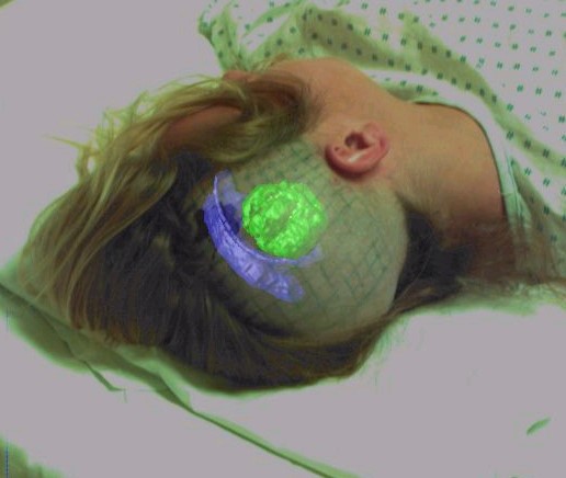Brain Surgery Navigation and Planning Tools | Bangkok International ...