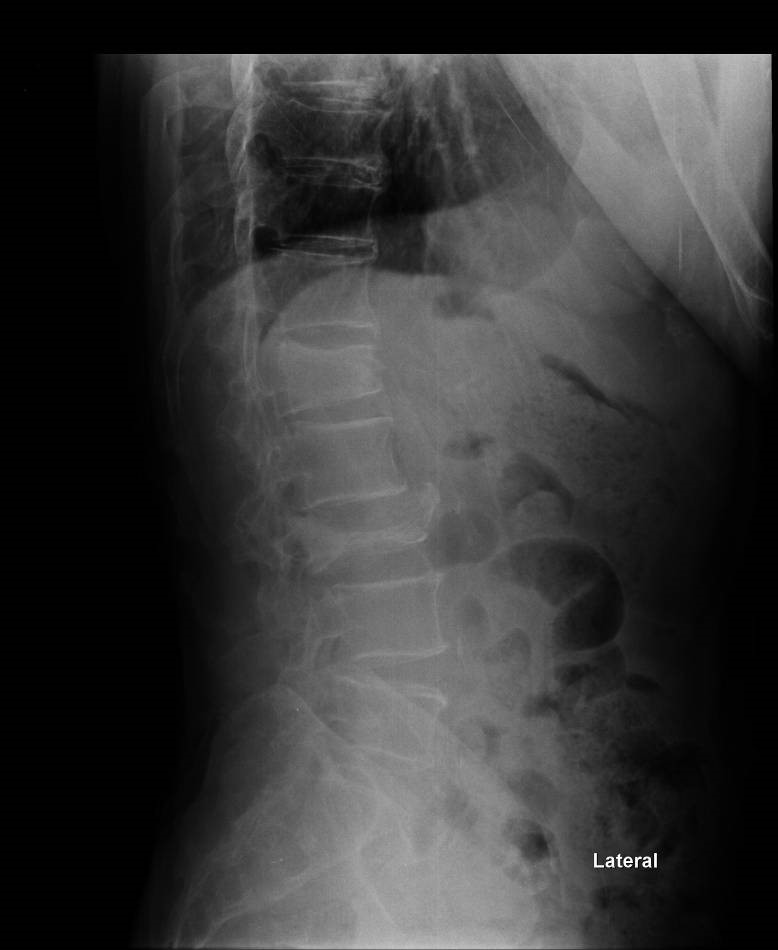 Osteoporosis is Preventable | Bangkok International Hospital (Brain x Bone)