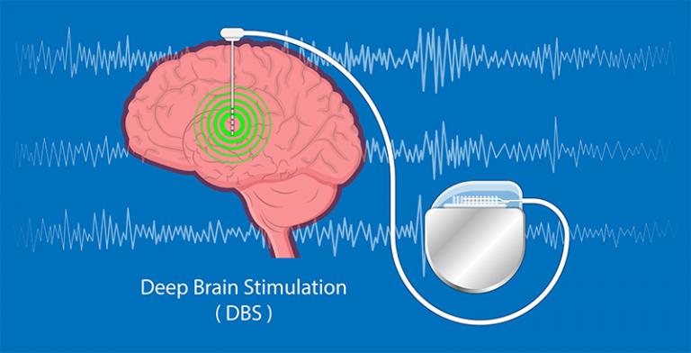 Deep Brain Stimulation (DBS): New Way to Treat Parkinson’s Disease ...