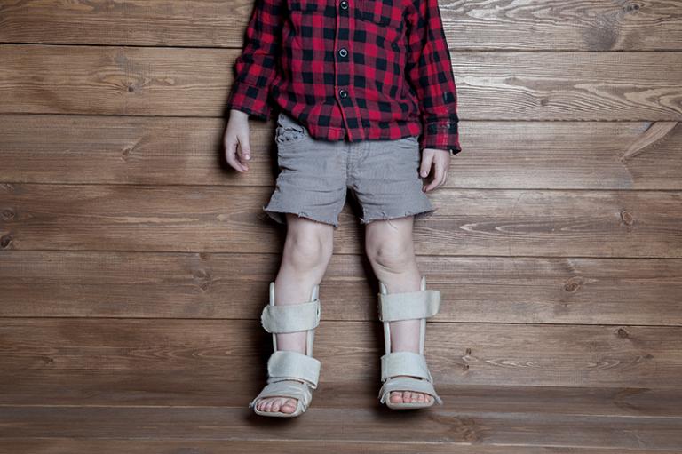 6 Deformities of the Foot in Infants | Bangkok International Hospital ...