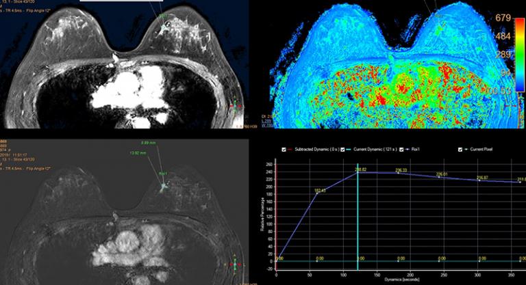Breast cancer diagnosis by using magnetic resonance imaging (MRI ...