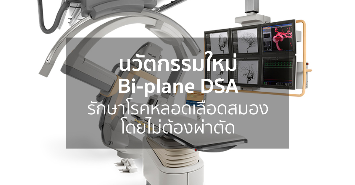 นวัตกรรมใหม่ ‘Bi-plane DSA’ รักษาโรคหลอดเลือดสมองโดยไม่ต้องผ่าตัด ...