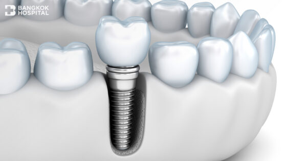 Smartlife: Innovative Computer Guided Implant Surgery | Bangkok ...