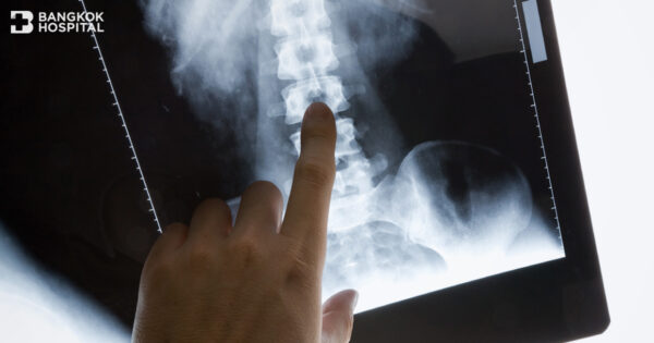 Direct Lateral Interbody Fusion (DLIF) | Bangkok International Hospital ...