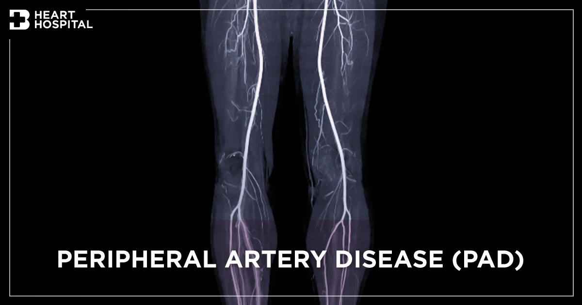 Peripheral artery disease (PAD) | Bangkok Heart Hospital