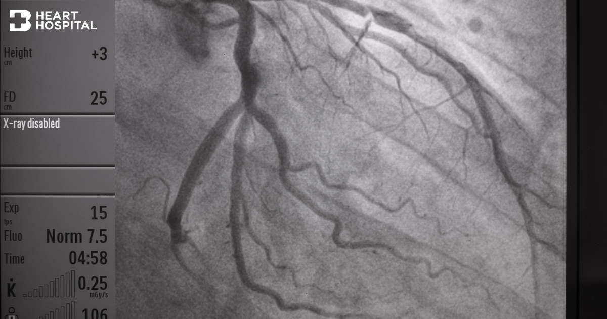 ตรวจสวนหลอดเลือดหัวใจ (Coronary Angiogram) | โรงพยาบาลหัวใจกรุงเทพ