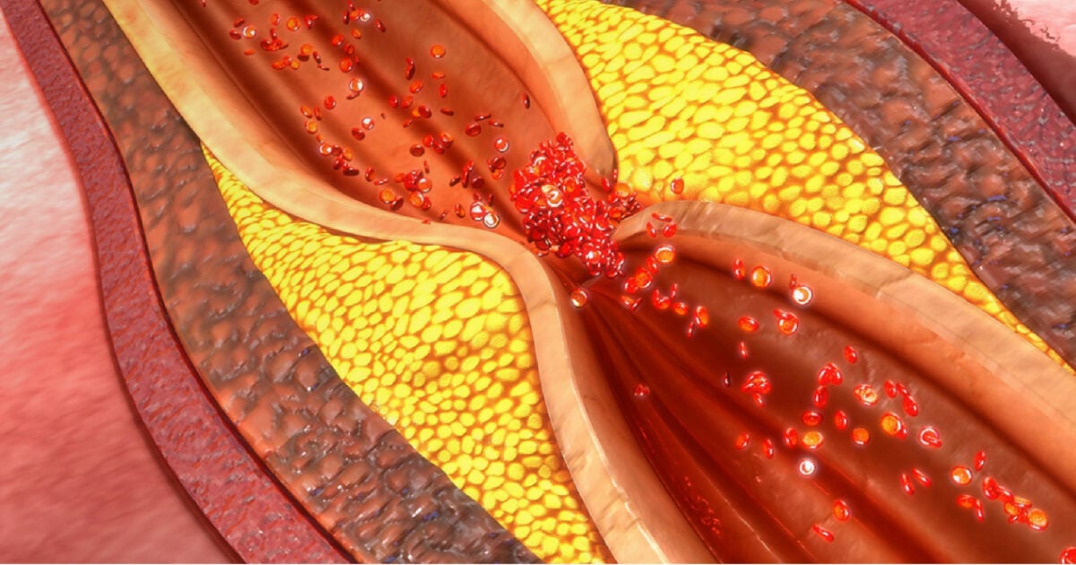 Coronary artery occlusion can be life-threatening if not treated ...