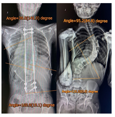 MAGEC: An effective spinal surgery to treat spinal scoliosis in ...