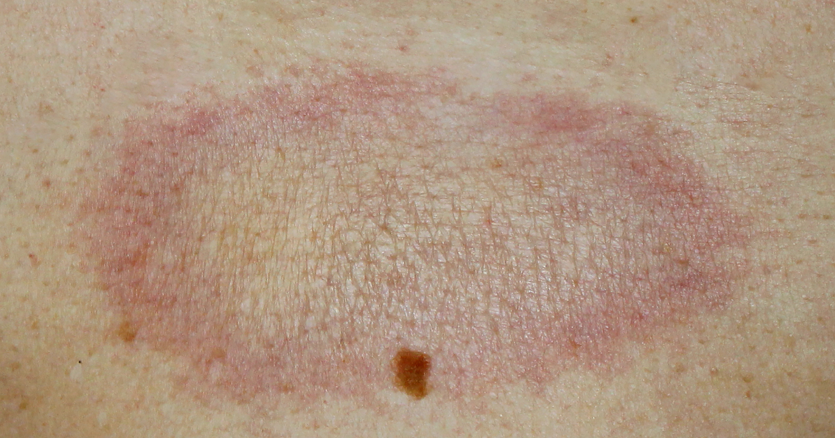 MORPHEA: A Skin Condition That Can Be Detrimental To Your Self ...