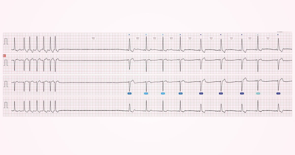 តើចង្វាក់បេះដូងរបស់អ្នកយឺតប៉ុណ្ណា អ្នកត្រូវទៅជួបគ្រូពេទ្យ។ | Bangkok ...