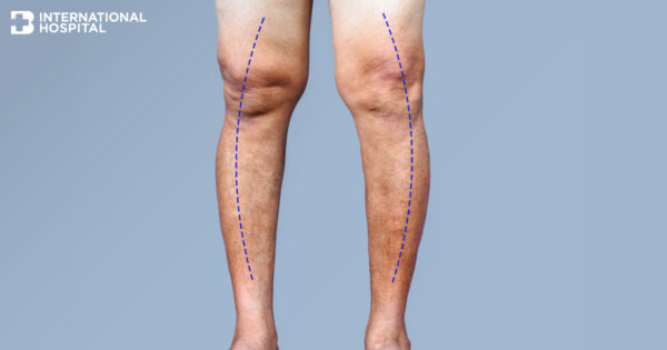 Knock Knees, Bowlegs, and How to Correct Them | Bangkok International ...
