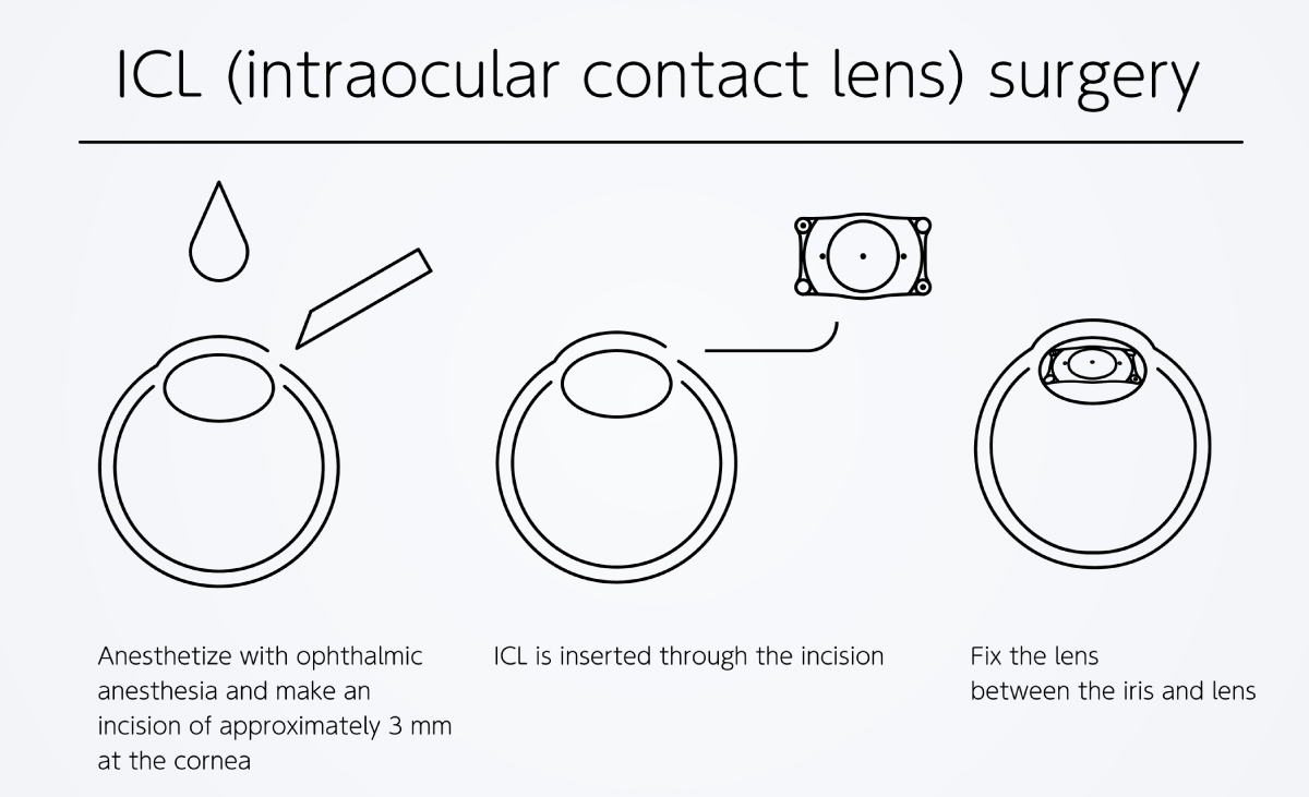 ICL เลนส์เสริม คืนความคมชัดให้ดวงตา | โรงพยาบาลกรุงเทพ สำนักงานใหญ่
