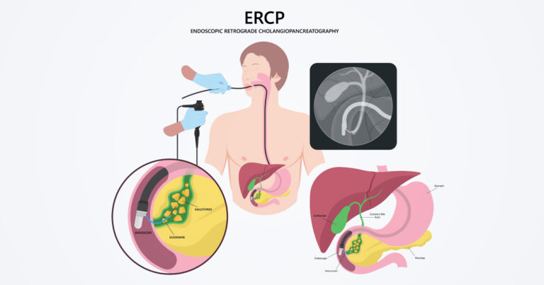 Why should ERCP be performed at Bangkok Hospital? | Bangkok Hospital ...
