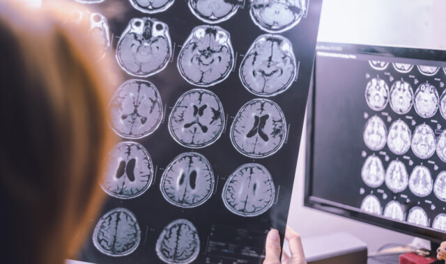 Bleeding in the brain is a serious danger to life. | Bangkok ...