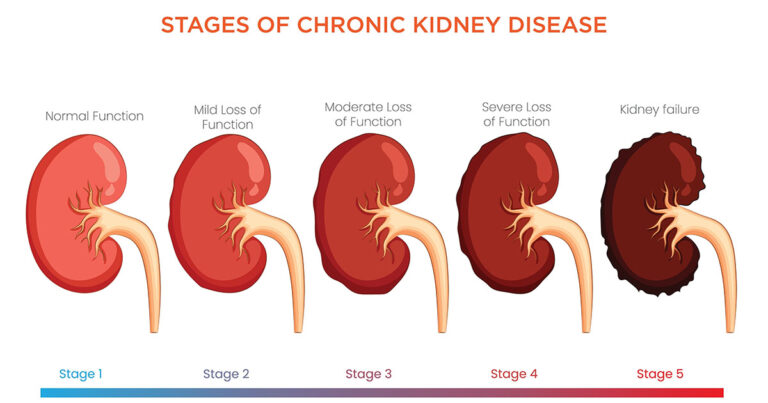 Hypertension and diabetes: Causes of chronic kidney disease | Bangkok ...