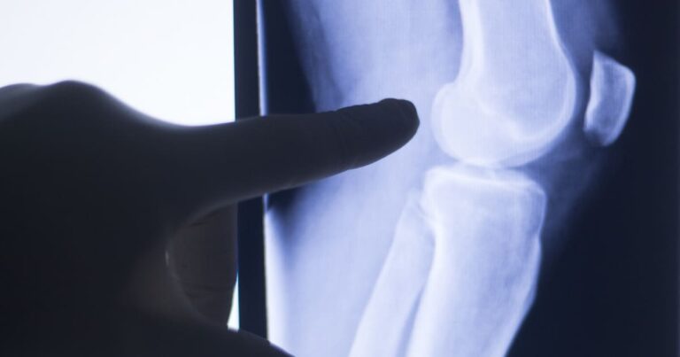 高齢者の膝の腫れは、変形性膝関節症の警告サインです。 | Bangkok International Hospital (Brain x Bone)