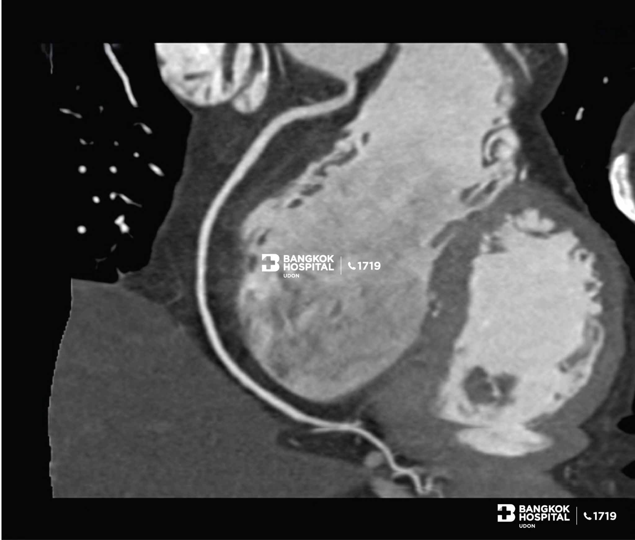 AI-Powered Heart CT Scan with PHILIPS CT 5300 – First in Thailand ...