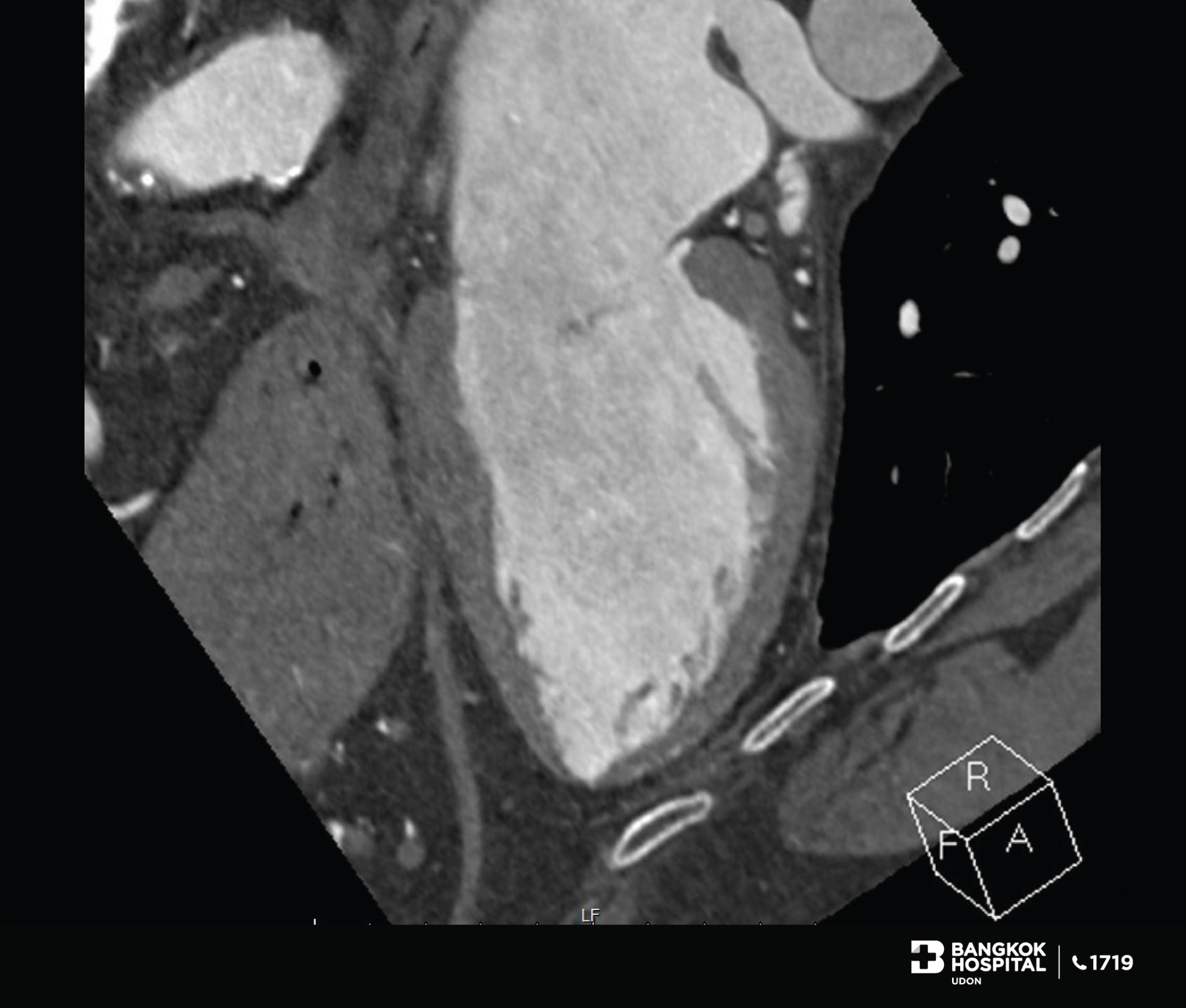 AI-Powered Heart CT Scan with PHILIPS CT 5300 – First in Thailand ...