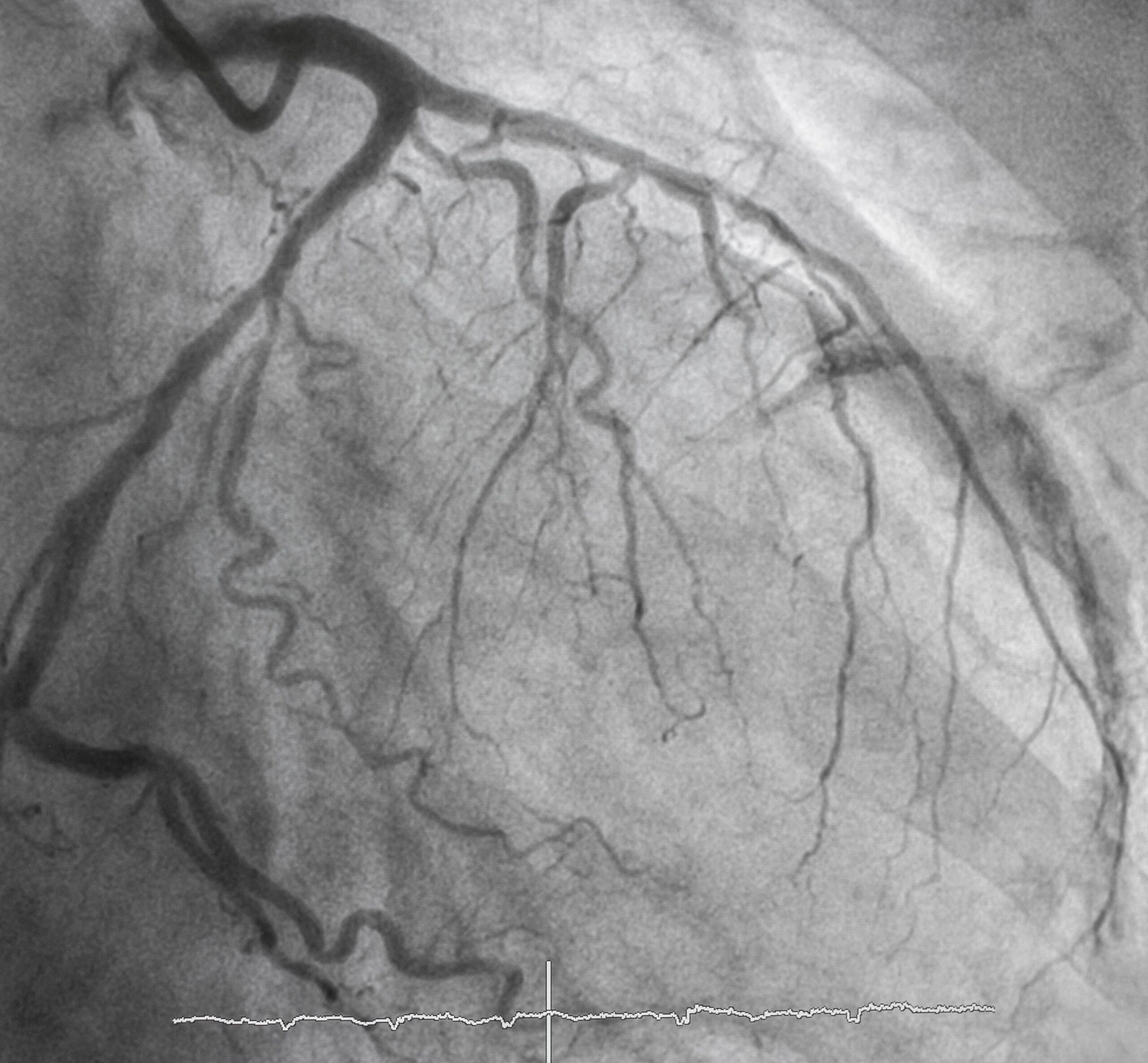 Coronary Artery Disease: Understand Deeply Before Deciding on Treatment | Bangkok Heart Hospital