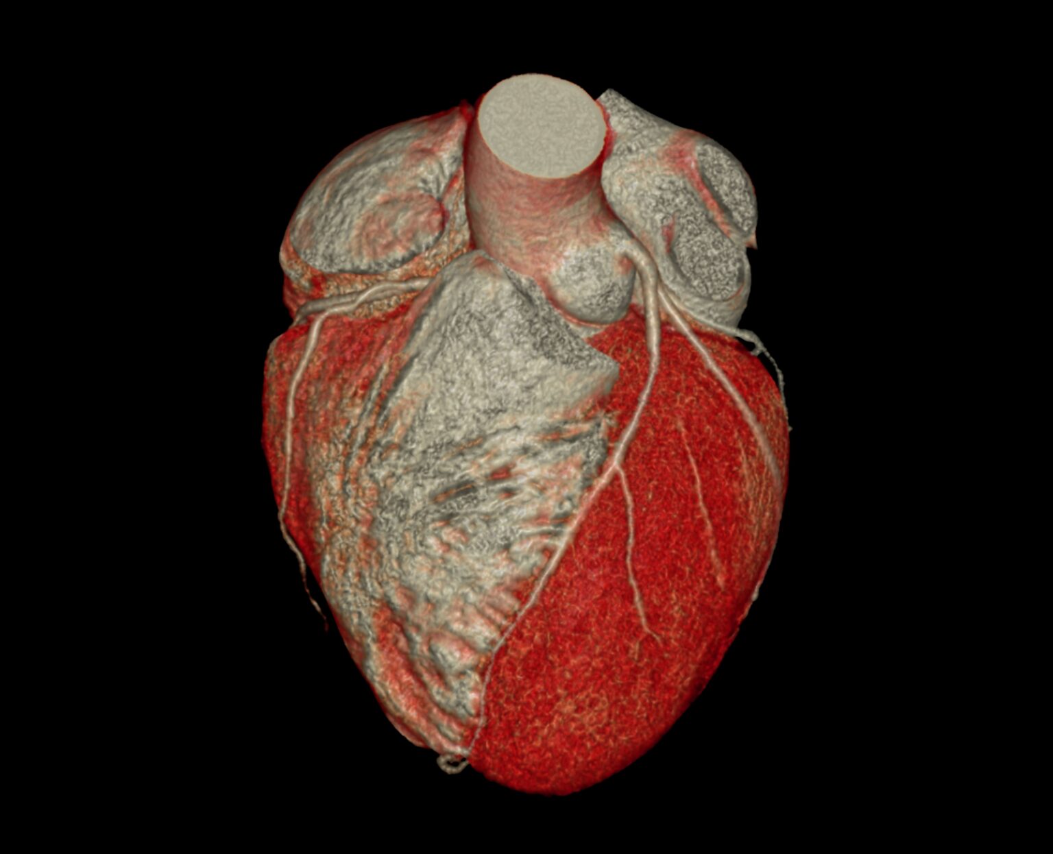 Coronary Artery Disease: Understand Deeply Before Deciding on Treatment ...