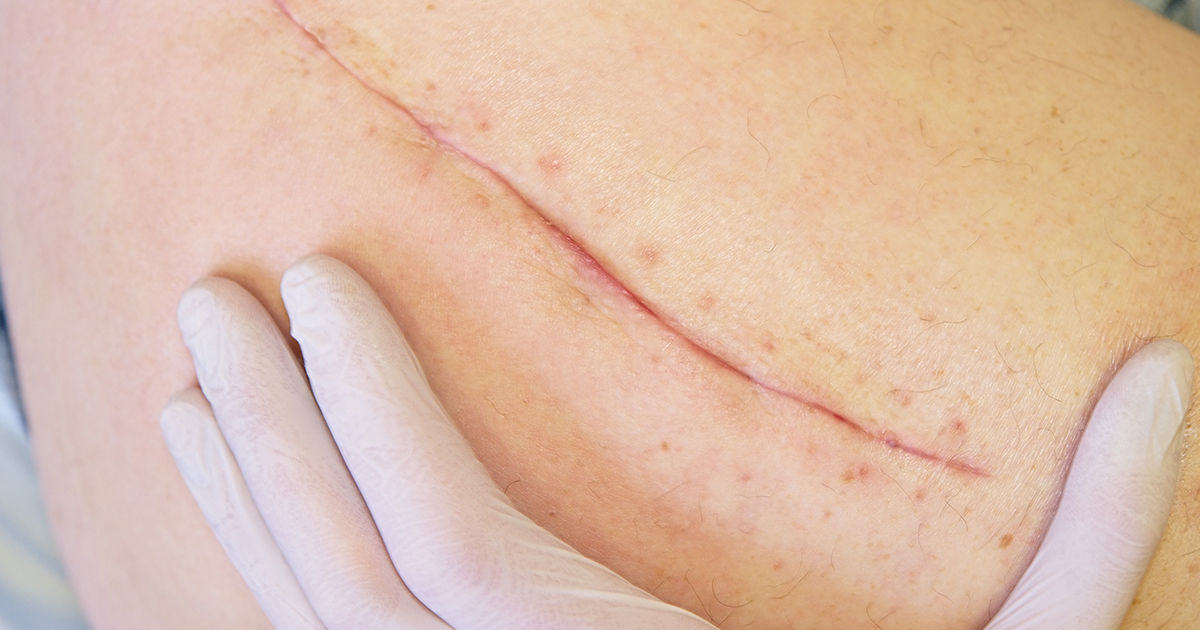Scar Revision | Bangkok Hospital Pattaya