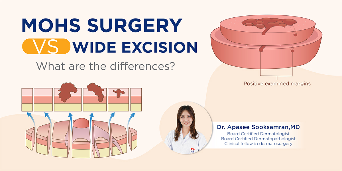 Mohs Surgery VS Wide Excision What are the differences? | Bangkok ...