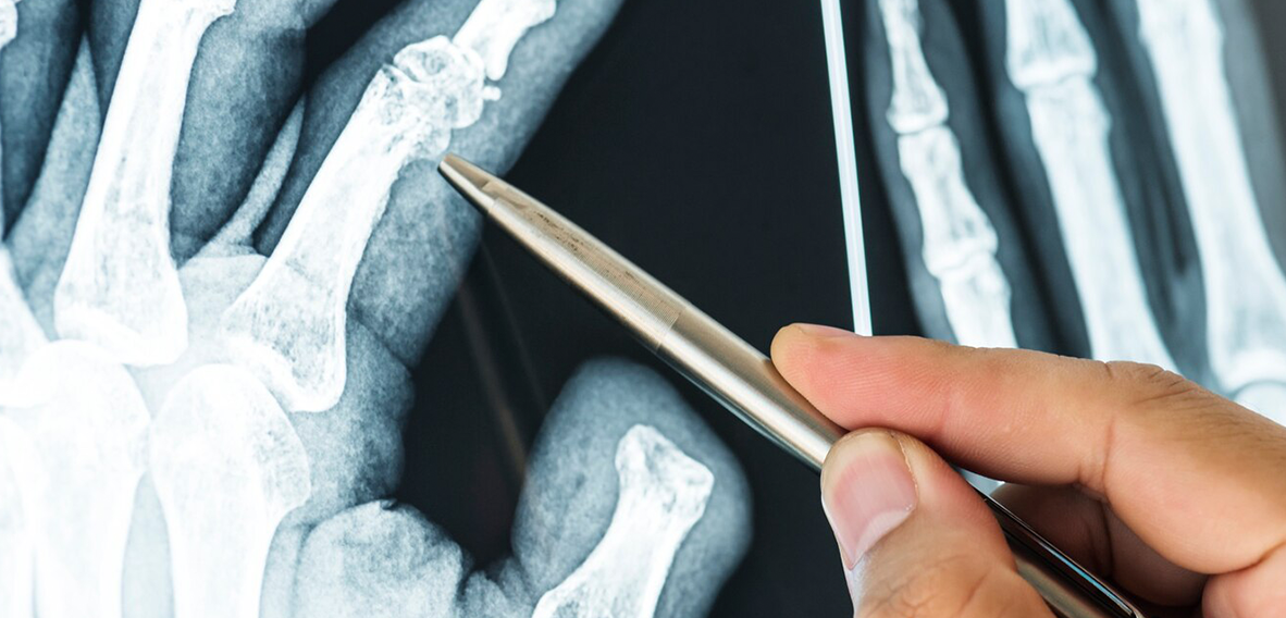 A Complete Guide to Understanding Fractures: Types, Symptoms, Treatment ...