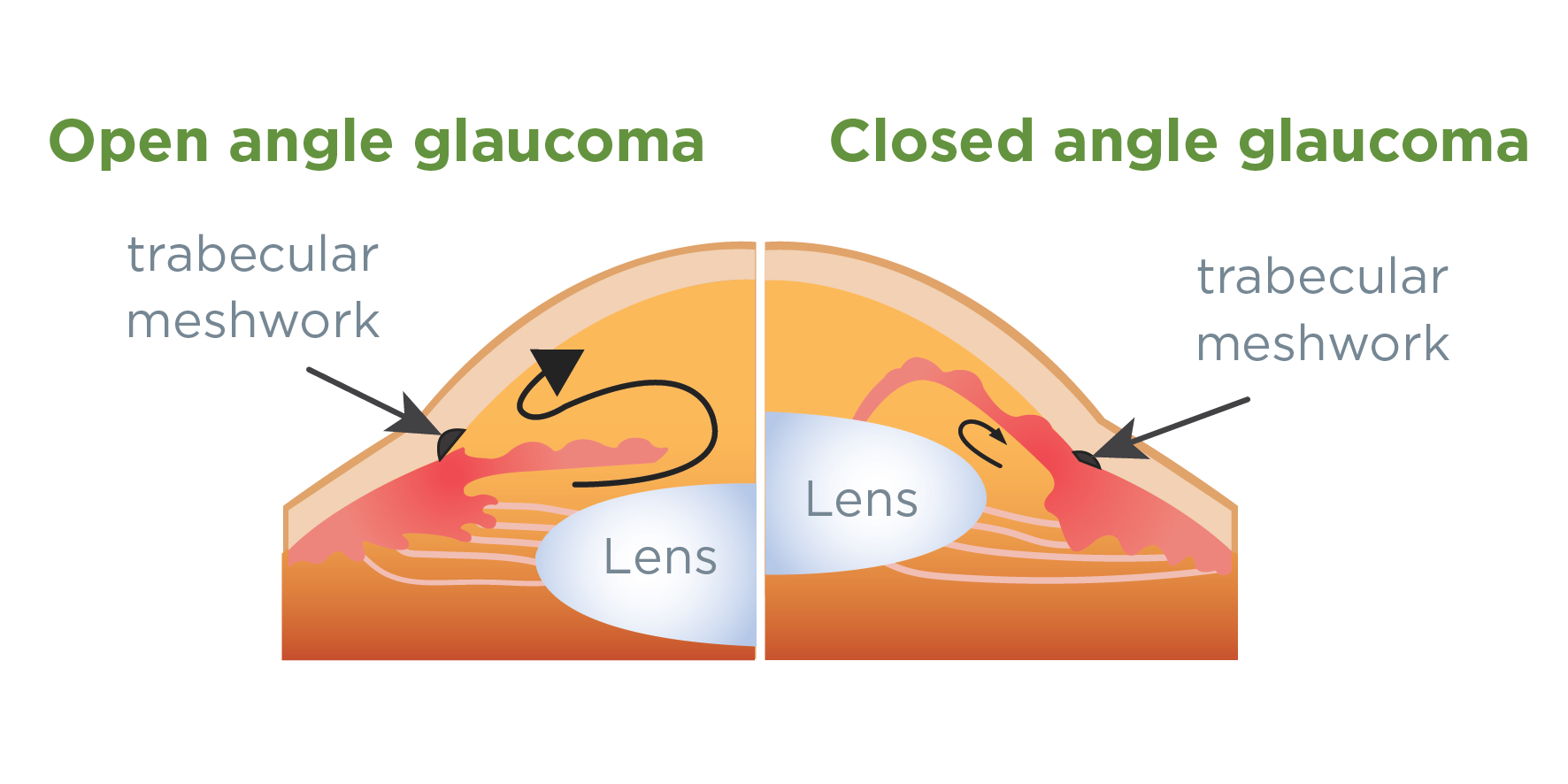 Glaucoma | Bangkok Hospital Phuket