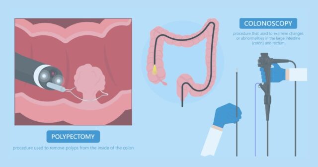 ESD Endoscopic treatment of polyps and early-stage cancer in the ...